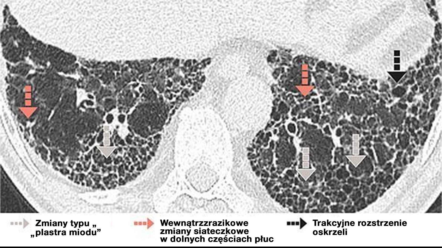 Ocena i rozpoznanie ILD - Obrazowanie PF metodą HRCT