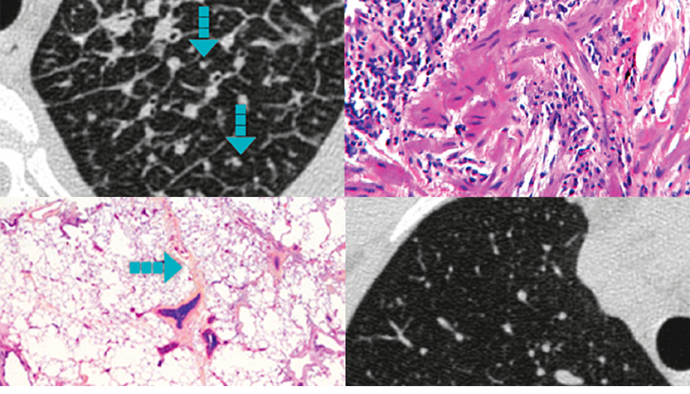 Role of HRCT in ILD diagnosis | Pulmonary Fibrosis 360