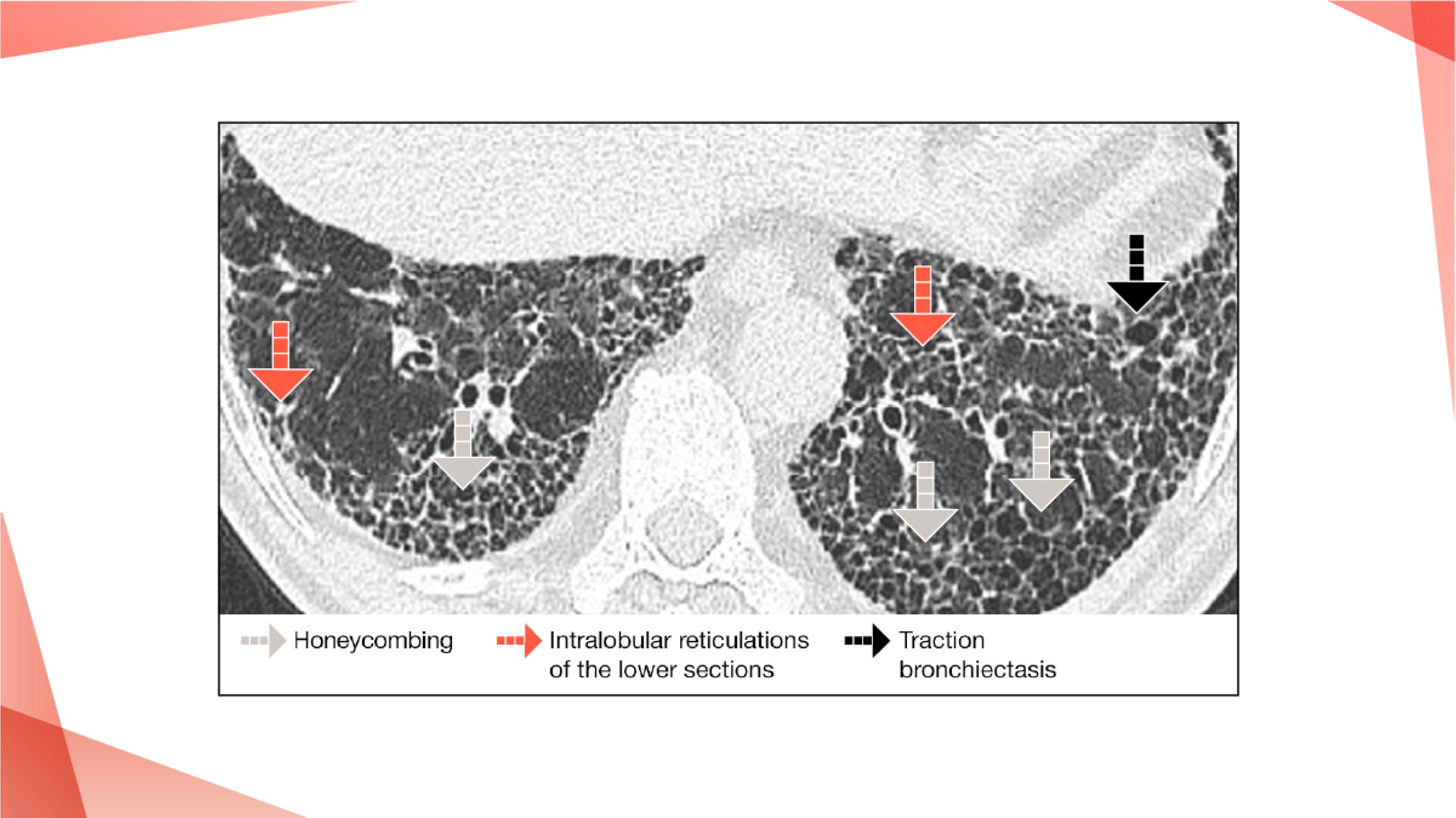Recognize Fibrotic ILD on HRCT | PulmonaryFibrosis360.com